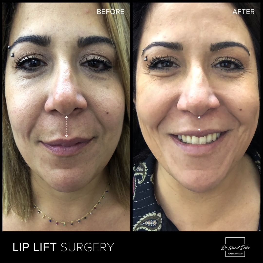 Subtle and Elegant Lip Lift Surgery | Dr. Saad Dibo